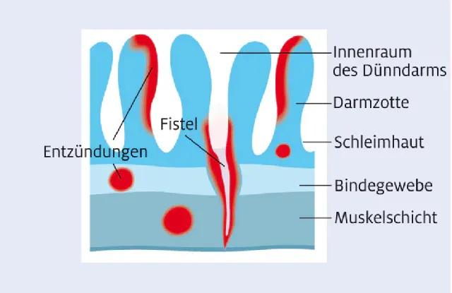 Chronisch-entzündliche Darmerkrankungen im Alter: Ein Leben mit Colitis ...